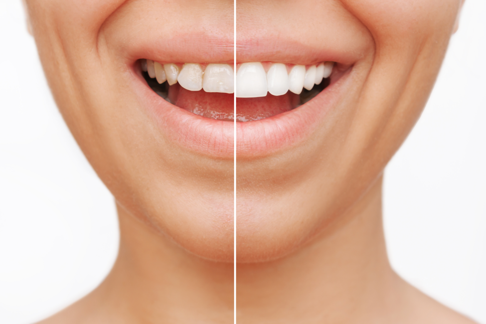 Can Cosmetic Dentistry Address My Short Teeth? | Dr. Joseph Costa